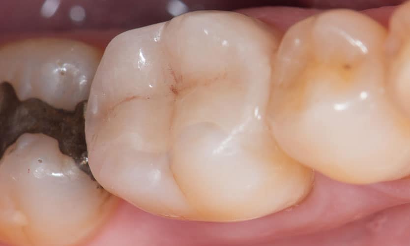 White Fillings - Killoran Dental
