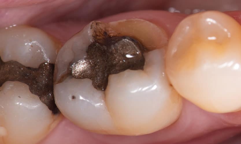 White Fillings - Killoran Dental